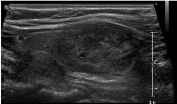 TIRADS ACR : What Radiologists need to know | RadioGyan.com - RadioGyan