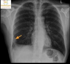Hampton's hump | Radiology Signs
