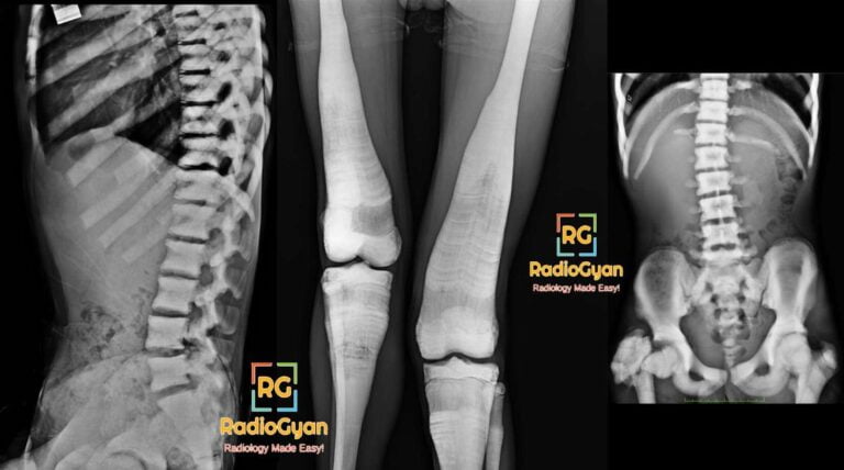 Erlenmeyer flask deformity | Radiology Signs