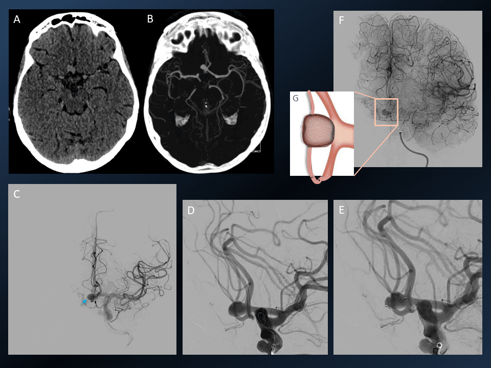 Interventional Radiology - All Your Questions Answered | Guides | RadioGyan