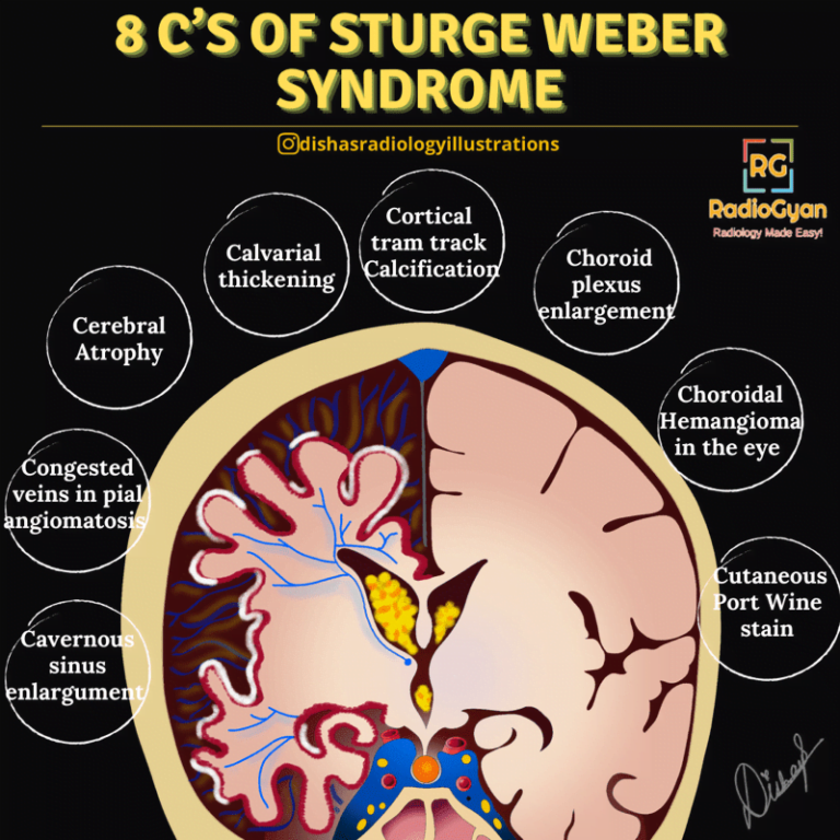 Sturge Weber Syndrome - Visual Mnemonics - RadioGyan
