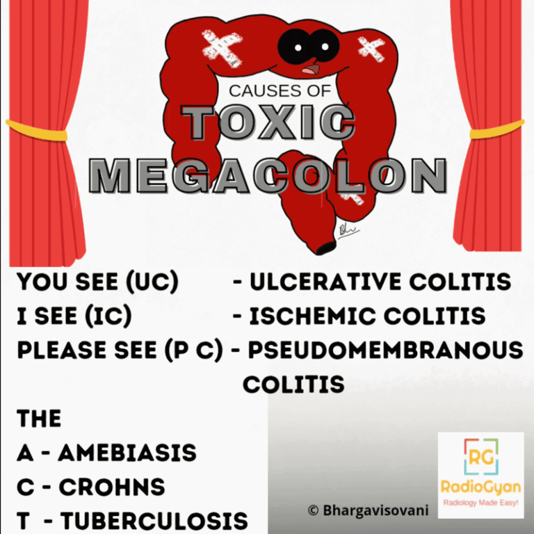 Causes Of Toxic Megacolon - Visual Mnemonics