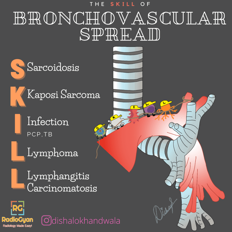 Diseases with Bronchovascular Spread - Visual Mnemonics - RadioGyan