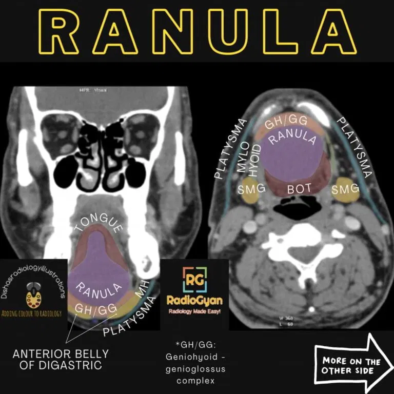 Ranula | Radiology Case | - RadioGyan