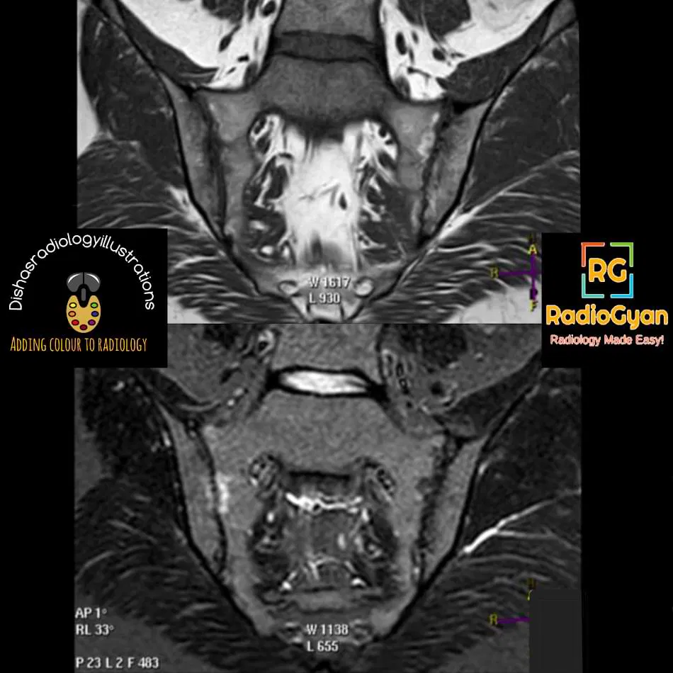 Sacroilitis | Radiology Case