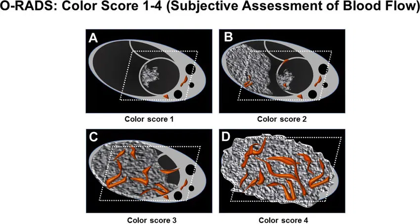 O-RADS Ultrasound Calculator - ACR Guidelines - RadioGyan