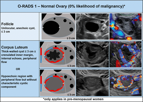 O-RADS Ultrasound Calculator - ACR Guidelines - RadioGyan