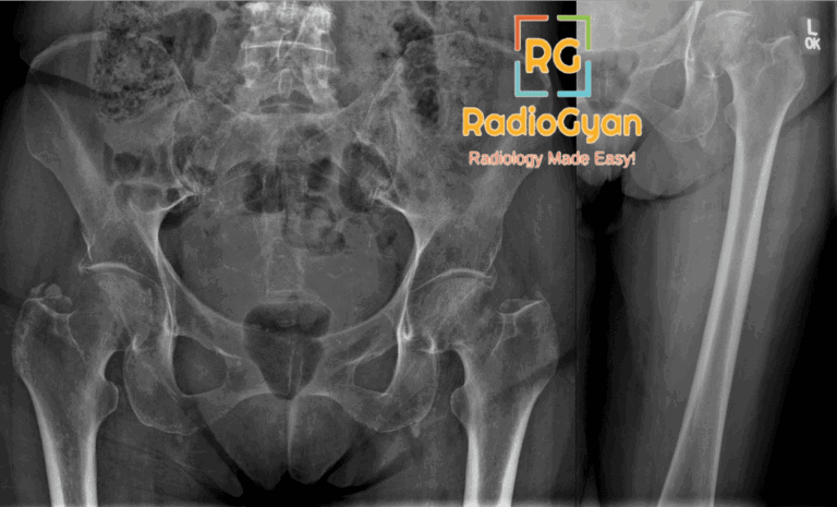 Proximal Femoral Fractures - Radiology Case - RadioGyan