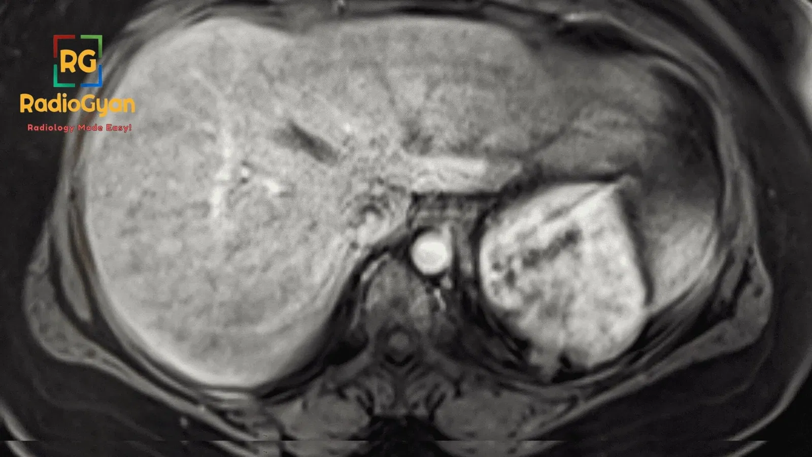 Transient Severe Respiratory Motion artefacts in Gd-EOB-DTPA