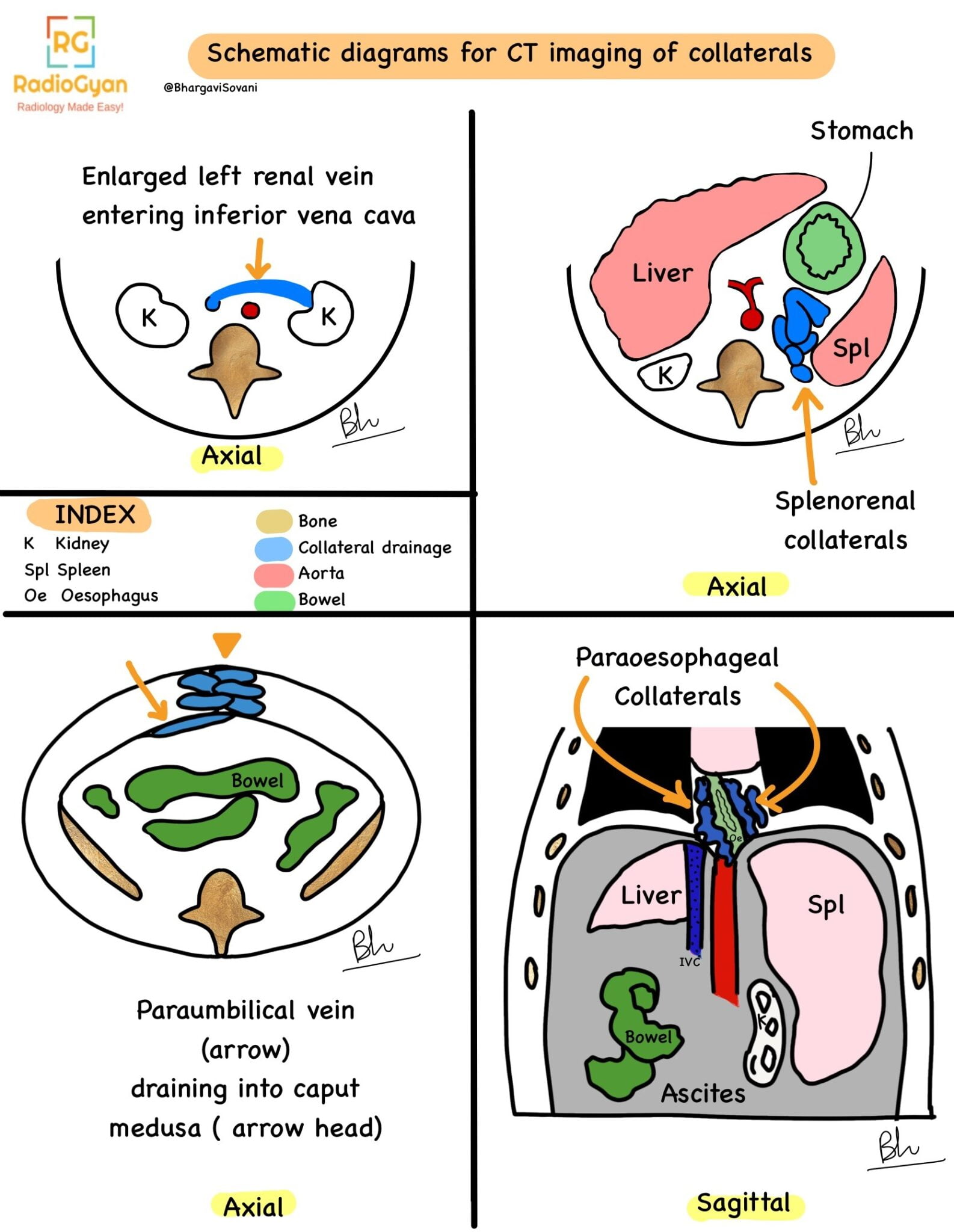 Cirrhosis and Portal Hypertension