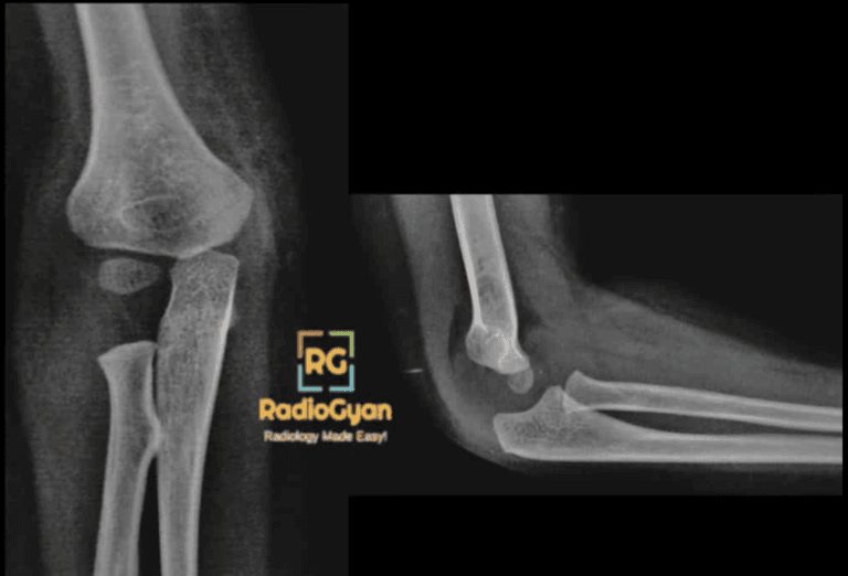 Fat pad sign | Radiology Signs