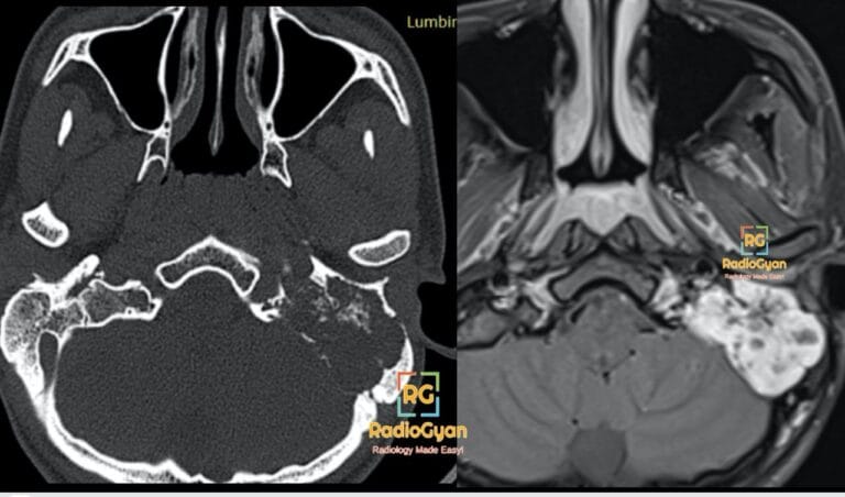 Left Glomus Jugulare Paraganglioma