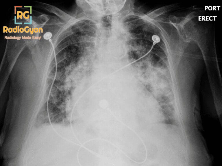 Bat Wing Appearance Radiology Signs
